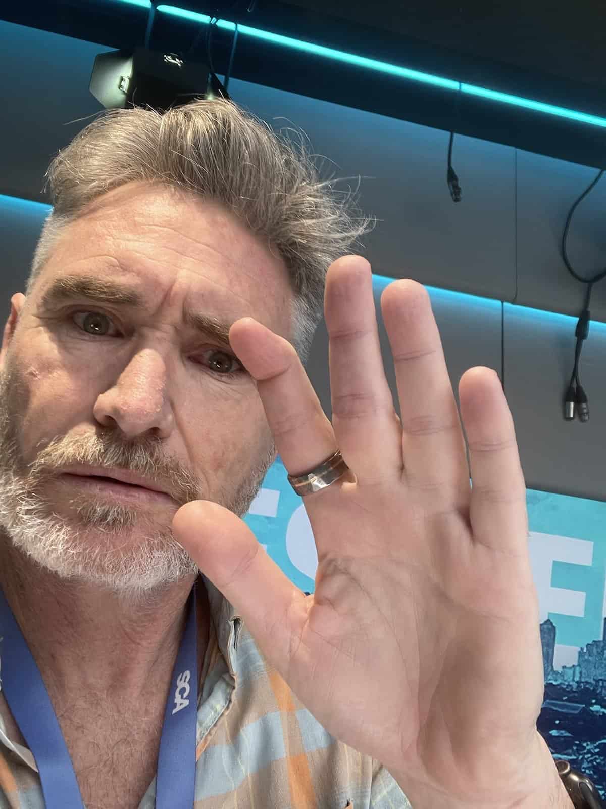 Hughesy Dislocated His Finger In Most Bizarre Way Possible