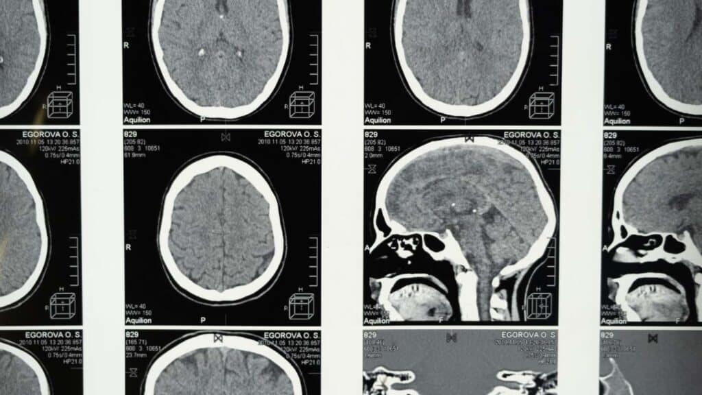 What A Post-Mortem Brain Exam Can Tell Us About How Someone Died (Or ...