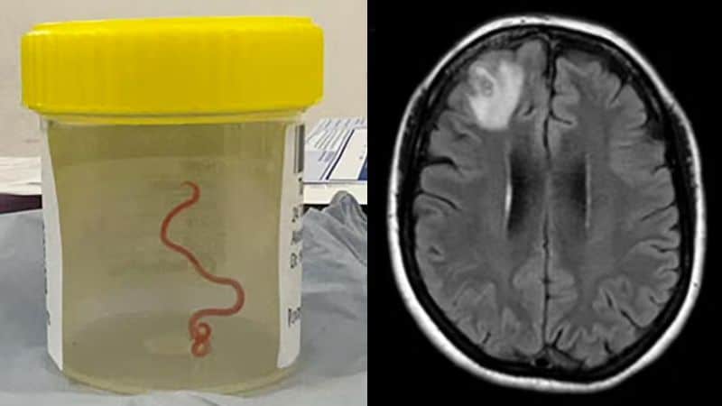 Live Parasitic Roundworm Found In Patient’s Brain By Australian Surgeon