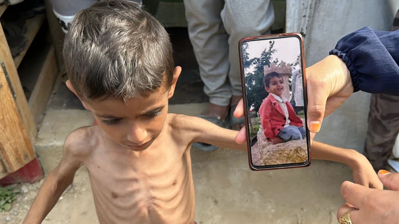 Over 5,800 Gaza children face acute malnutrition